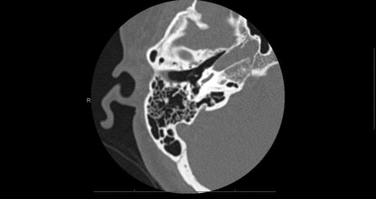 Importance of aural rehabilitation following cochlear implantation ...
