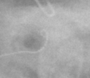 Case study: Intraoperative correction of a CI632 placement using the ...