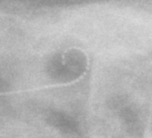 Case study: Intraoperative correction of a CI632 placement using the ...