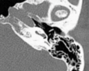 Case study: Intraoperative correction of a CI632 placement using the ...