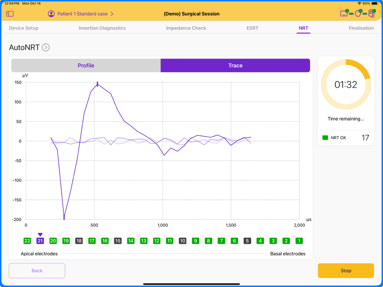 A Deeper Dive Into Nucleus® Smartnav Intraoperative Testing Cochlear
