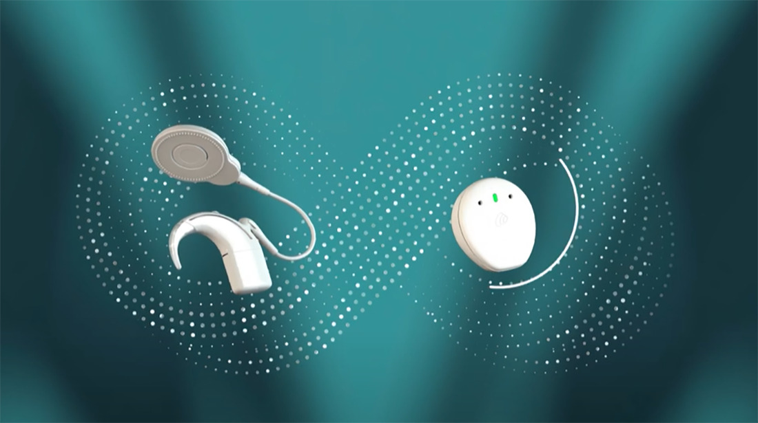 Cochlear Launches World’s First and Only Smart Cochlear Implant System ...